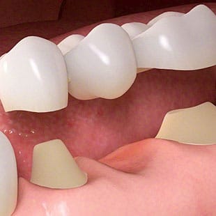 Same Day Crowns Sugar Land TX | FLOSS Dental Sugar Land